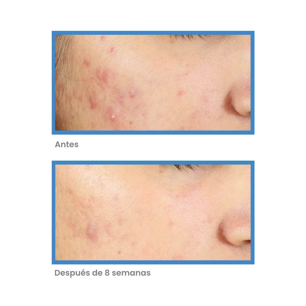 DEEP RELIEF BLEMISH TREATMENT (TRATAMIENTO PARA ACNÉ SEVERO) > Sephora MX